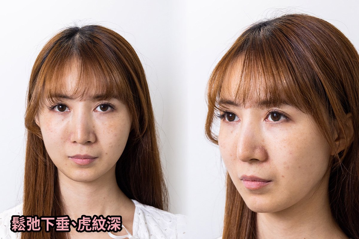 30代美編實測BTL EMFACE™療程！鍛鍊面部肌肉，同時激生膠原，逆齡不是夢！